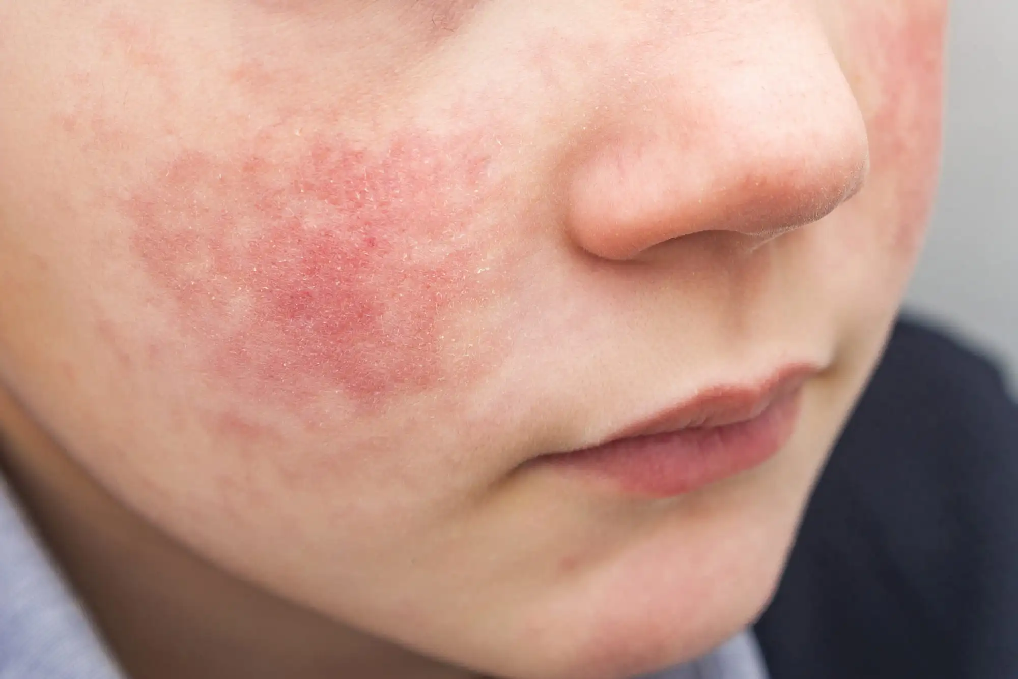 Eczema Treatment in Boston, MA | Regeneris MedSpa