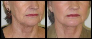 Understanding Platysmal Bands | Causes and Treatments